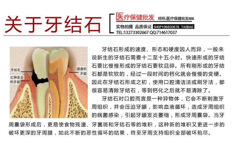 牙结石分度及图片洗牙掉的牙结石图片第3页大山谷图库